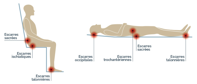 Chirurgie des escarres - Fondation Hopale